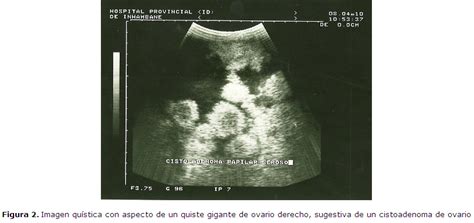 Quiste Gigante De Ovario Y Mioma Uterino Presentación De Un Caso