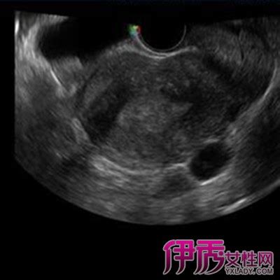 阴超能检查出什么图阴超能检查出什么 阴超的七大功能揭晓 3 伊秀健康 yxlady