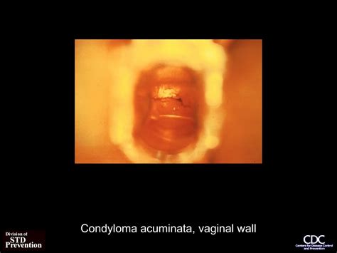 Condylomaacuminata Or Study On Candiasisppt