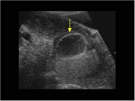 Gynaecology 32 Adnexa Case 321 Benign Cystic Lesions