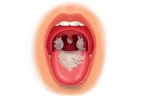 What You Need To Know About Deadly Diphtheria Infection The Nation