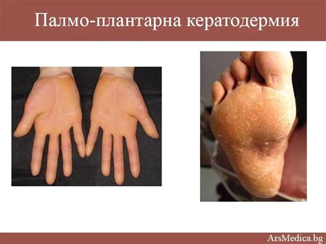 Rdw ширина на разпределение на еритроцитите Arsmedica Bg