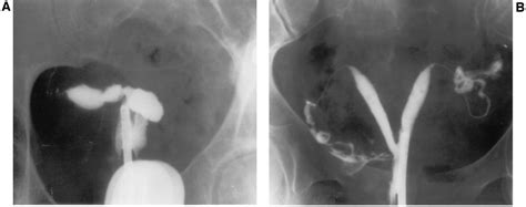 Hysterosalpingography Fertility And Sterility