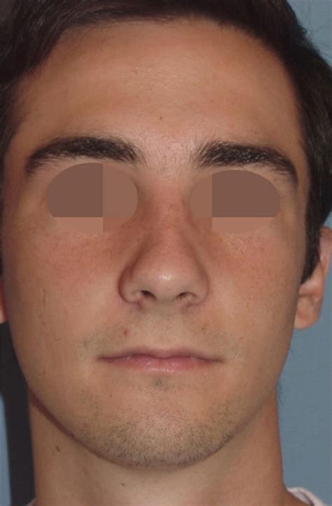 Male Rhinoplasty 12 Robert A Guida Md Pc