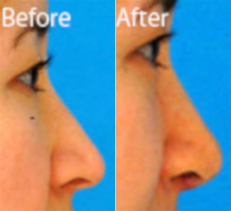 Asian Rhinoplasty From Nasal Bridge To Tip Refinement