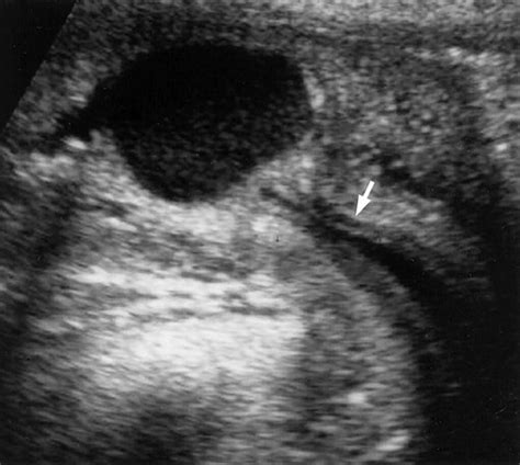 Cross Sectional Imaging Of The Female Urethra Technique And Results