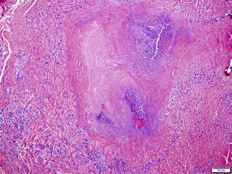 Pathology Outlines Rheumatoid Rheumatic Nodules