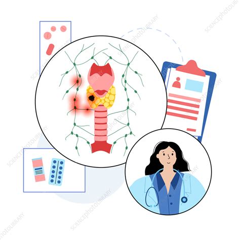Thyroid Cancer Illustration Stock Image F036 3928 Science Photo