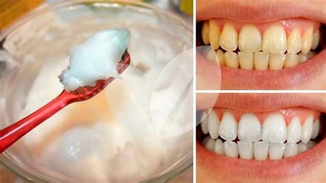 PLUSVISÃO EMPREENDEDORISMO COMO CLAREAR NATURALMENTE SEUS DENTES EM