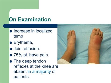Charcot Joint Arthropathy Pptx Pptx