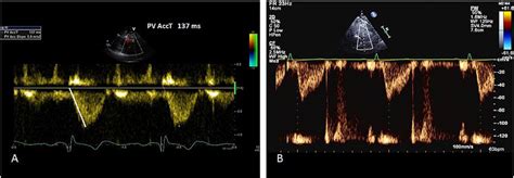 Rvot Acceleration Time Method For Assessing Pulmonary Pressure
