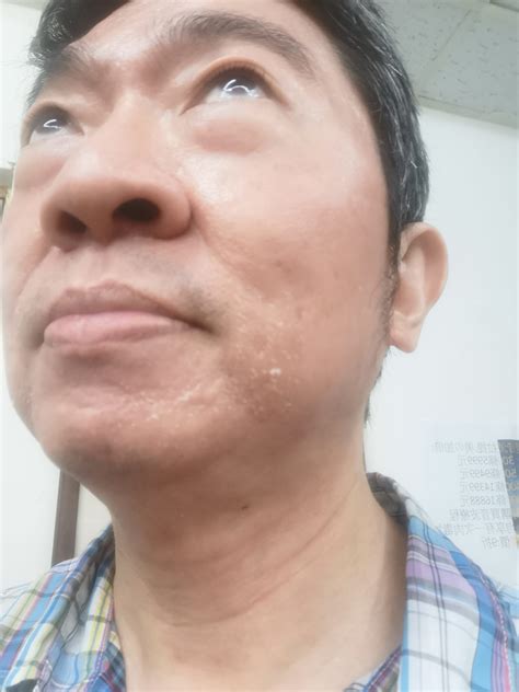 成安診所 開始脫皮。
