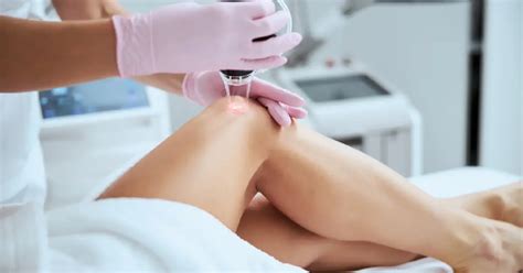 Say Goodbye To Spider Veins Uncover Proven Solutions