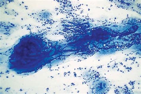 Mucinous Carcinoma Mucinous Medical