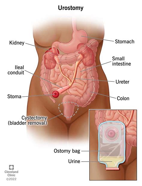 Urostomy Stoma
