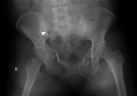 Pelvis Ap X Ray Of 66 Year Old Female White Arrow Indicates Sacral Download Scientific Diagram