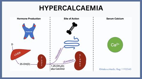 Hypercalcaemia Explained Youtube
