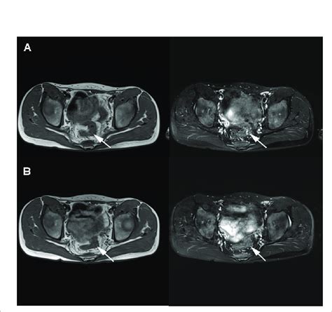 Mri Review In March 2021 After Neoadjuvant Immunotherapy Combined With