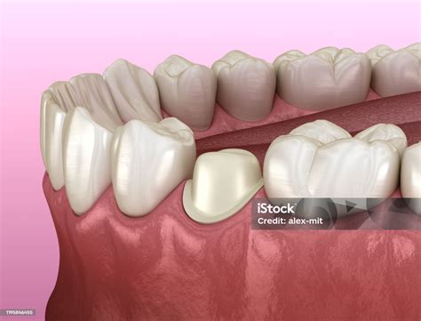 치과 용 금속 세라믹 크라운 배치를위한 프리포몰 치아 의학적으로 정확한 3d 일러스트레이션 건강관리와 의술에 대한 스톡 사진 및 기타 이미지 Istock