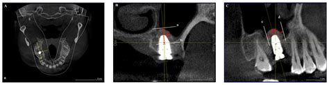 Jfb Free Full Text Resorption Rates Of Bone Graft Materials After