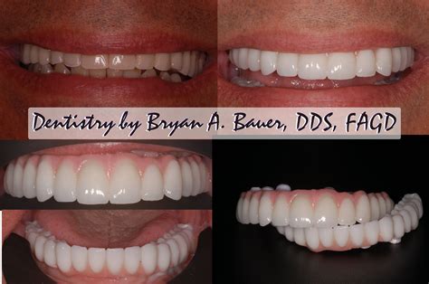 Implant Supported Denture Or Bridge All On Four All On 4