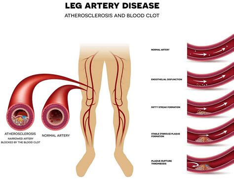 Peripheral Vascular Disease Causes Signs Symptoms Diagnosis And Treatment