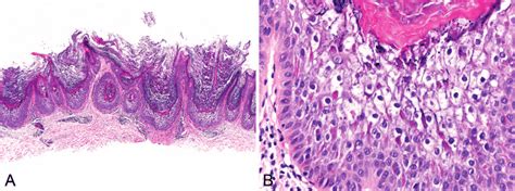 Epidermolytic Acanthoma A This Lesion Demonstrates Verruciform