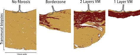 Multielectrode Unipolar Voltage Mapping And Electrogram Morphology To