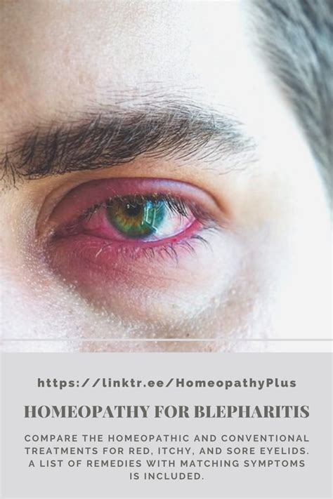 Homeopathy For Blepharitis Artofit