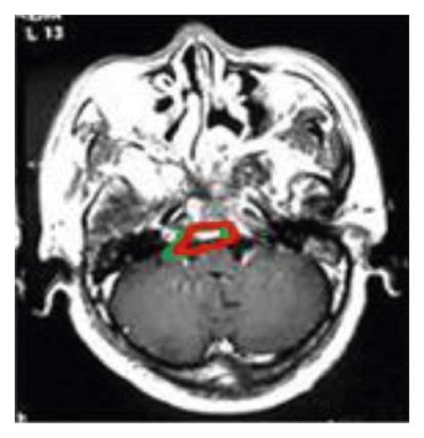 mri lesion segmentation results of npc lymph node metastasis male 37