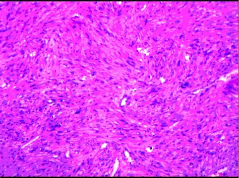 Image Showing Spindle Shaped Tumor Cells With Areas Of Hypercellularity