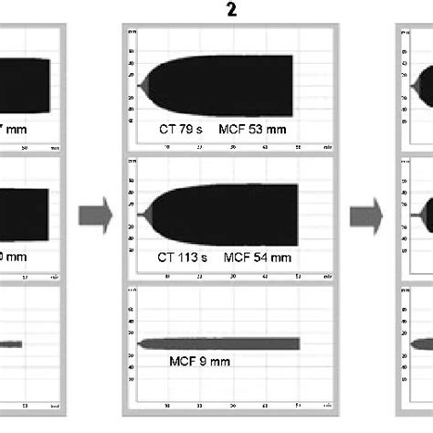 Analysis Of A Rotem Rotational Thrombelastometry Trace Coagulation Download Scientific
