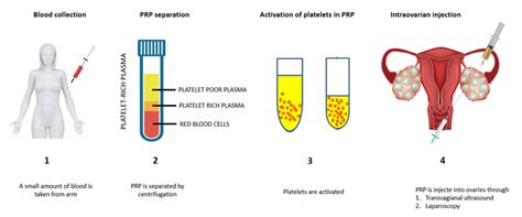 Schematic Representation Of Prp Preparation And Application Download