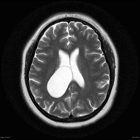 Arachnoid Cysts Neuropedia