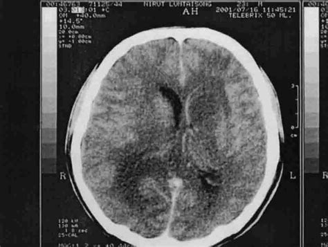 Computed Tomography Of The Brain Of The Patient Showing Two