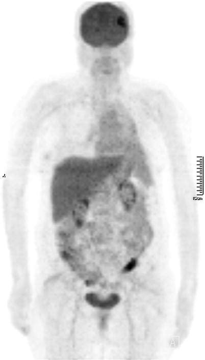 Lung Cancer Radiology Key