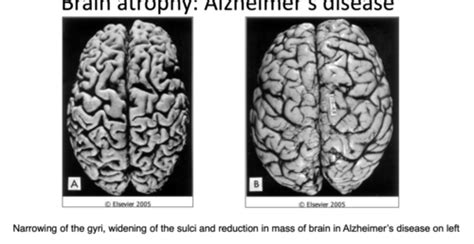 Neoplastic Non Neoplastic Disorders Of Cell Growth 40 Flashcards