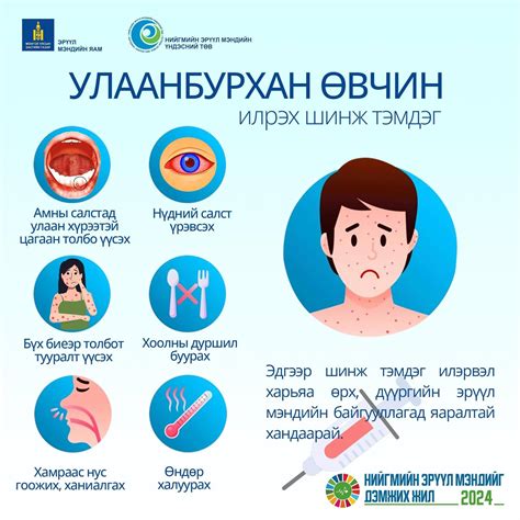 Өвөрхангай Танд улаанбурхан өвчний дараах шинж тэмдэг илэрвэл харьяа өрх дүүргийн эрүүл