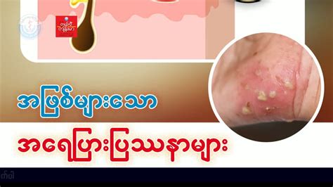 အဖြစ်များသော အရေပြားပြဿနာများ Youtube