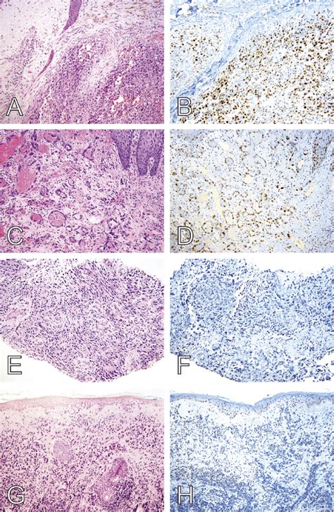 Ah Variable Myc Expression In De Novo Angiosarcoma As A C E G Download Scientific