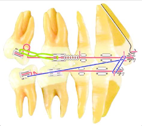Class Ii Force System Denture Correction A Coil Spring Is Trapped Download Scientific Diagram