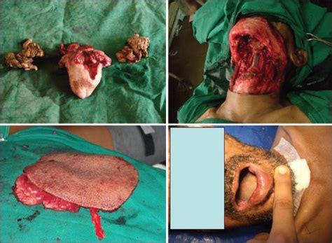Total Glossectomy With Anterolateral Thigh Free Flap Download
