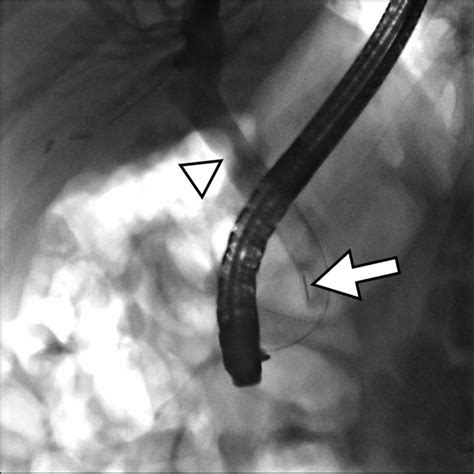 Endoscopic Retrograde Cholangiopancreatography Showing The Common Bile Download Scientific