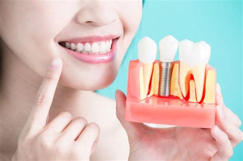 Single Tooth Implants What To Expect