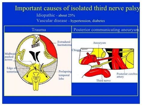 Oculomotor Nerve Pptx