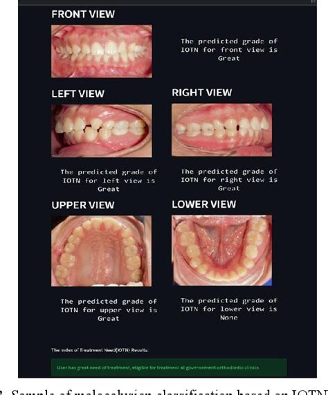 Figure 3 From Classification Of Malocclusion Using Convolutional Neural