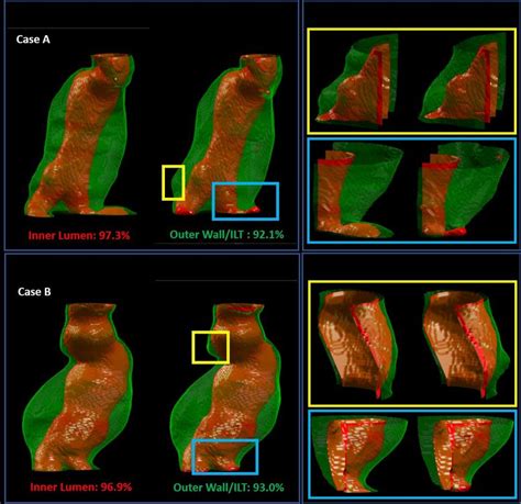 Attention Based 3d U Net Outputs For Two Patients Ac With The