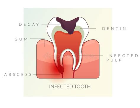 Infected Teeth Root Canal Treatment Stock Illustration Stock