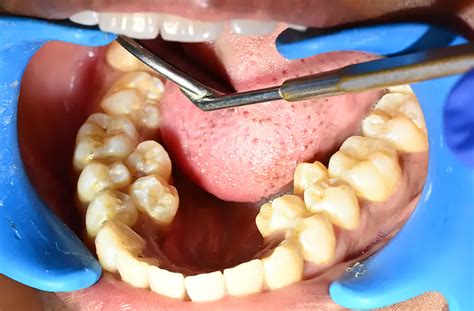 Com 38 Dentes Na Boca Indiana Entra Para O Livro Dos Recordes Da