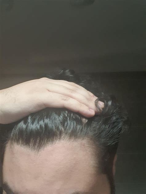 Is My Hairline Receding Or Normal Rbald